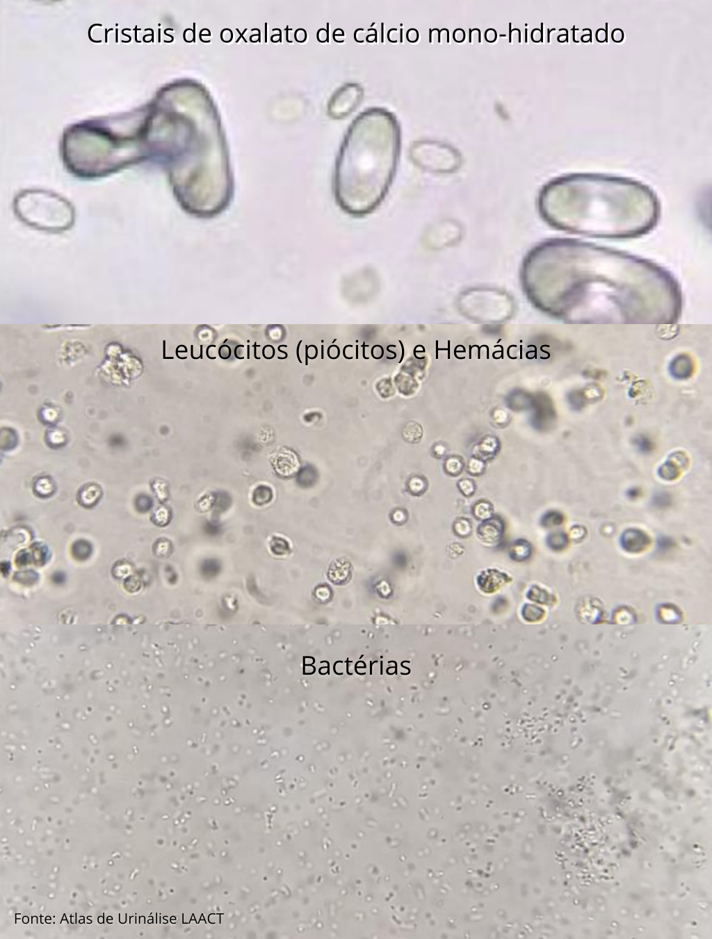 Leucócitos e cristais de oxalato de cálcio mono-hidratado na urina
