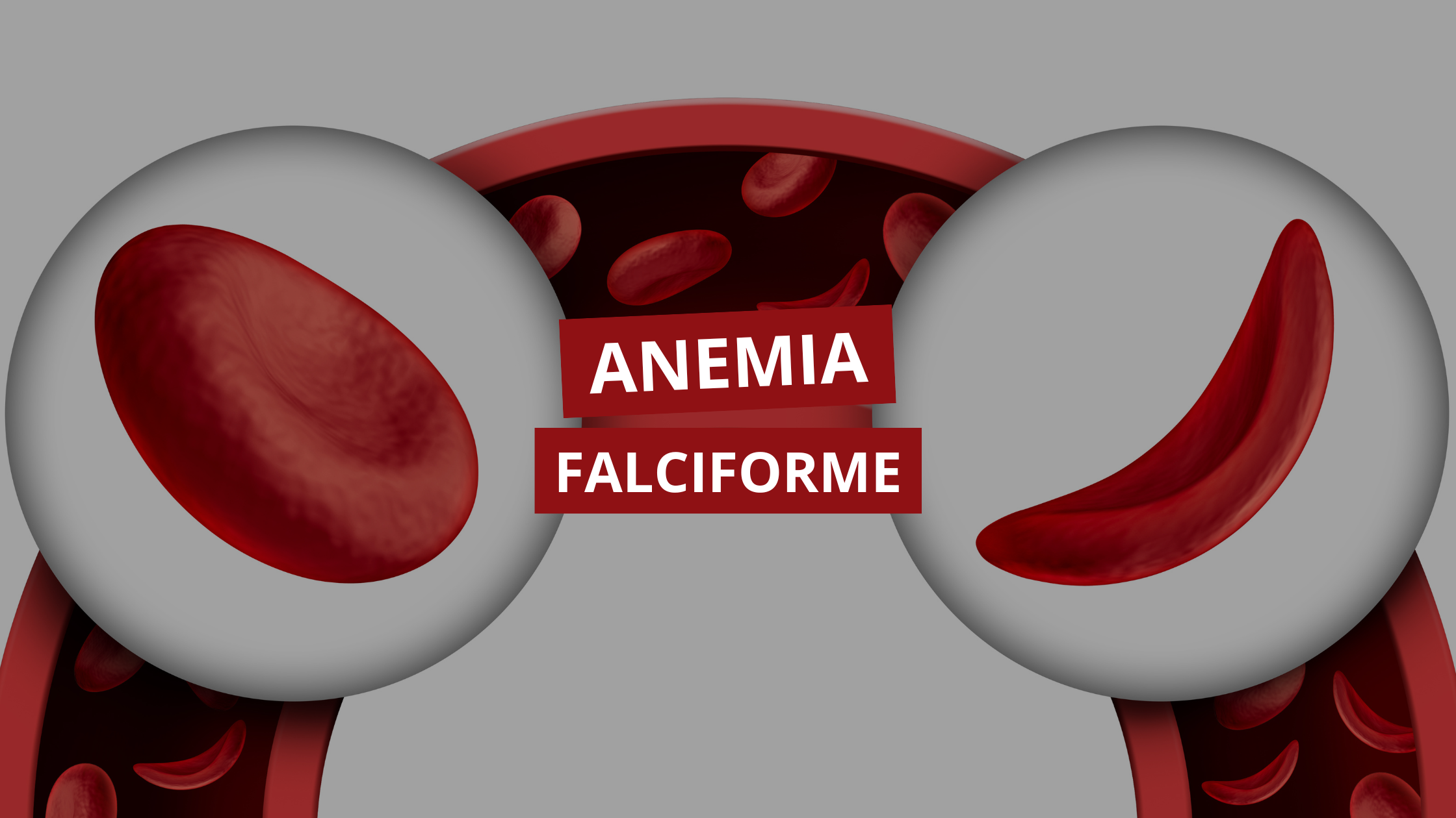 O que é anemia falciforme? - Cursau Educação - Blog